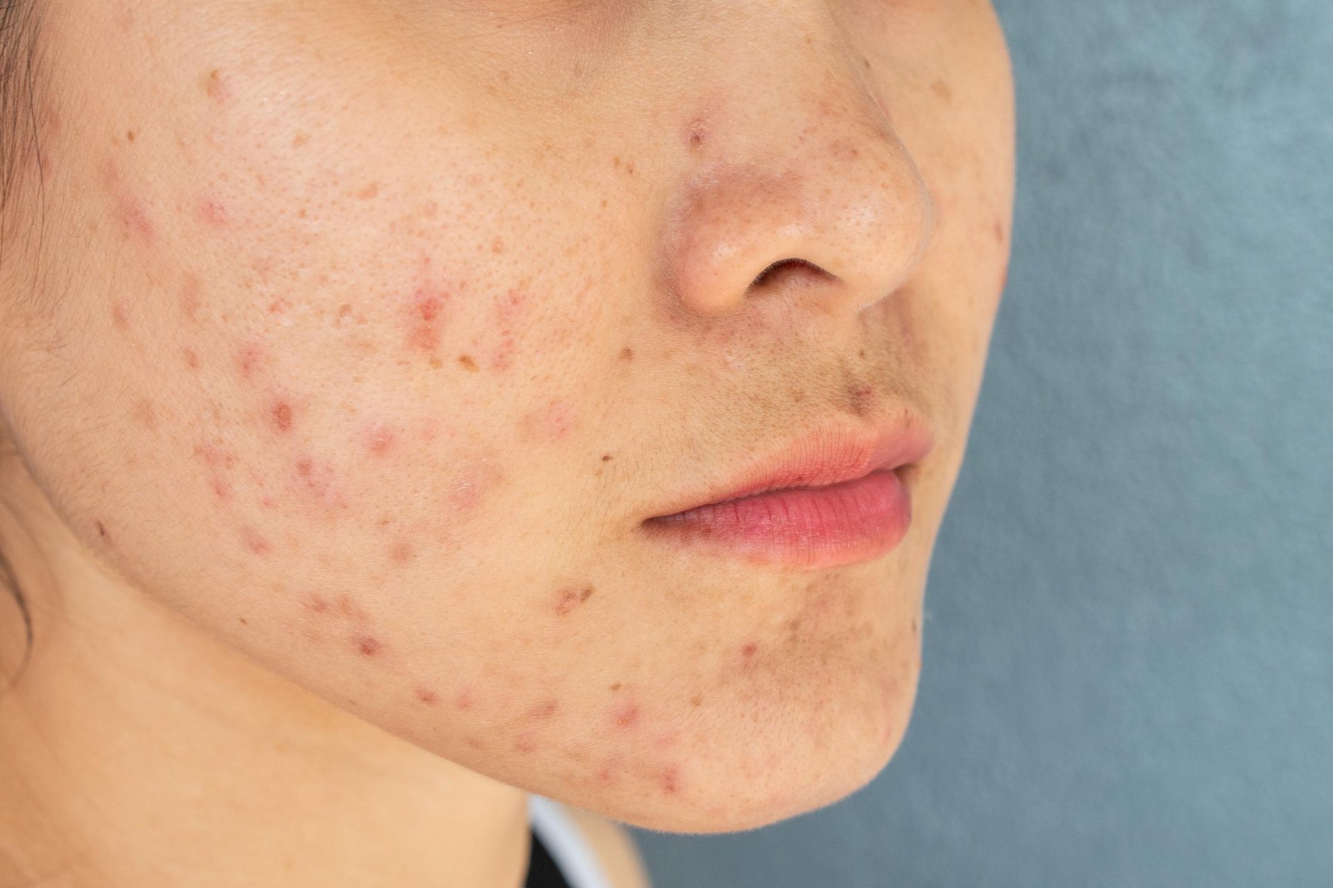 Was hilft wirklich gegen eine Akne tarda? | La Roche Posay