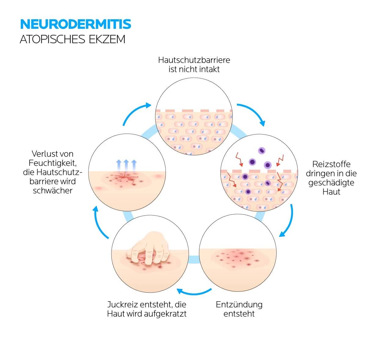 Neurodermitis: Ursachen und Hautpflege | La Roche Posay